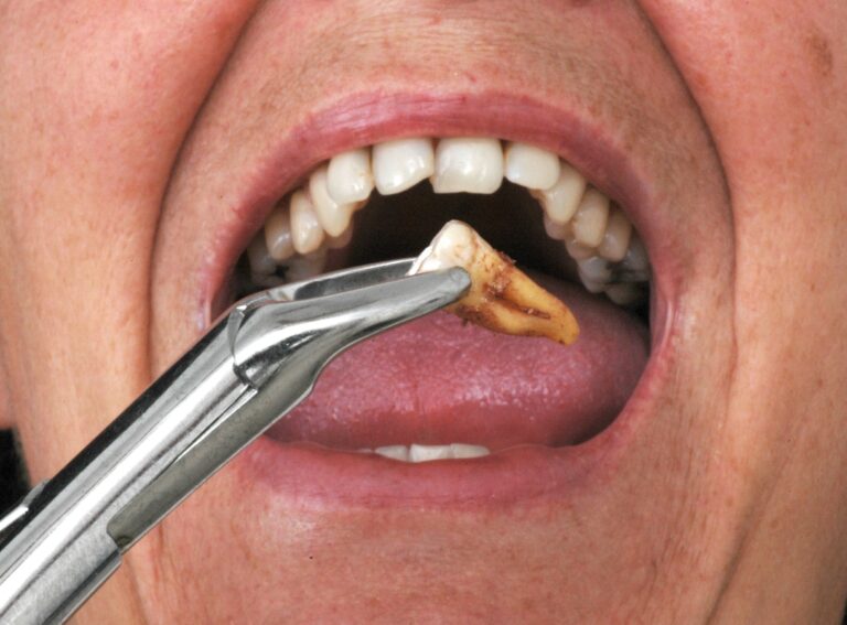 Tooth Extraction Surgery: Step-by-Step Breakdown